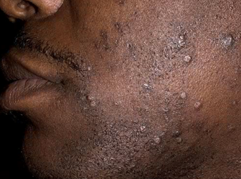 WHAT YOU NEED TO KNOW ABOUT HERPES - Lusaka Star